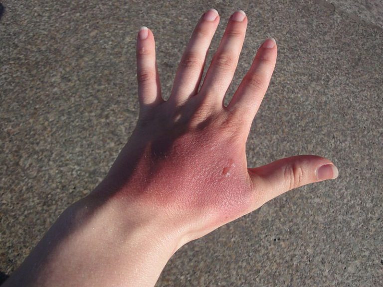 Safety tips for July 4th: Preventing firework burns